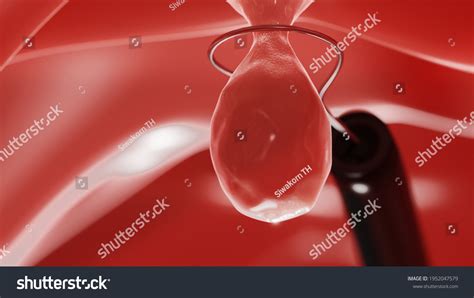 Image result for Colonoscopy Clips for Polyps