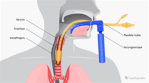Image result for Intaocular Intubation