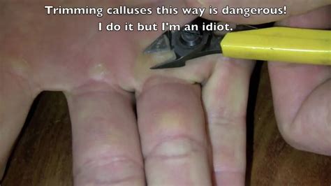 Image result for How to Remove Calluses From Hand