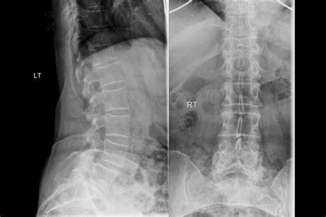Image result for Surgery for Compression Fracture