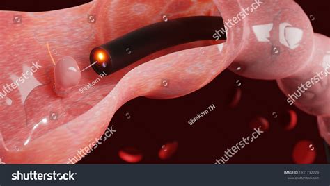 Image result for Control Colonoscopy of Polyps