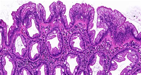 Image result for Colonoscopy Frequency Hyperpplastic Polyp