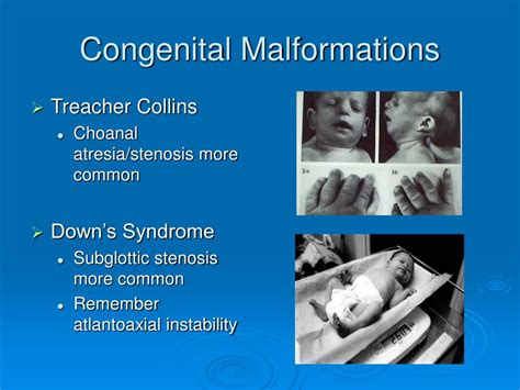 Image result for Neonatal Intubation