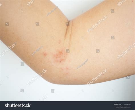 Image result for Shingles On Arm