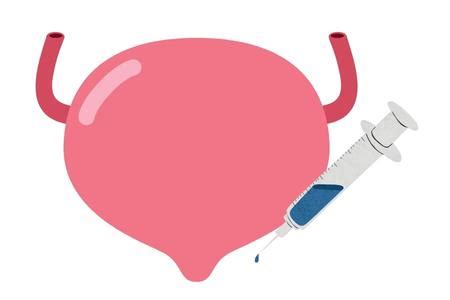 Image result for How Is Botox Injected into the Bladder