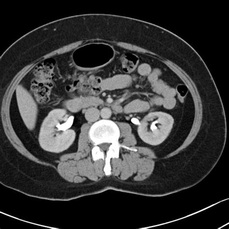 Image result for Urogram 3 Phase CT