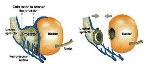 Image result for Simple vs Radical Prostatectomy
