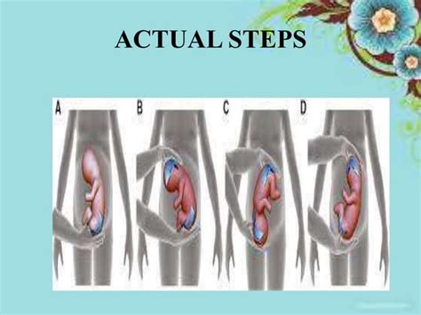 Image result for External Cephalic Version Step by Step