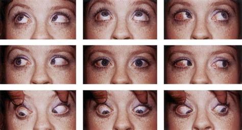 Image result for Exotropia and Computer