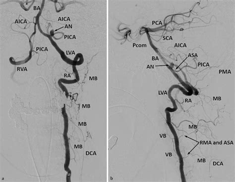 Image result for Spinal Angiogram