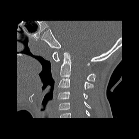 Image result for X-Rays for Basilar Invagination