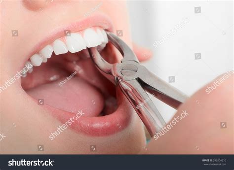 Image result for Tooth Extraction Forcep PHY