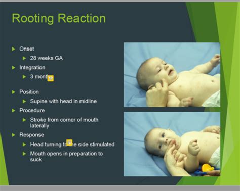 Image result for Persistent Primitive Reflex