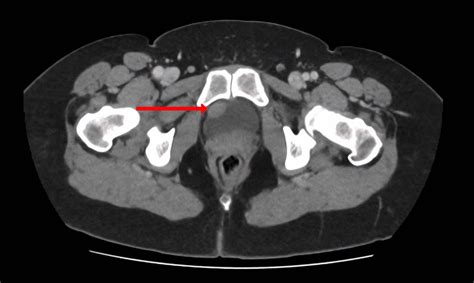 Image result for Volume-Rendered CT Urogram