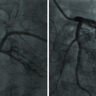 Image result for Normal Coronary Angiogram