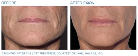 Image result for Applying Exoron