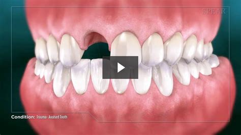 Image result for Avulsed Tooth