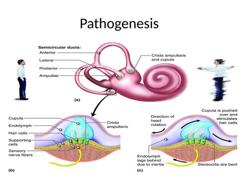 Image result for Positional Vertigo