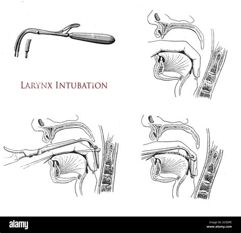 Image result for How to Do Intubation