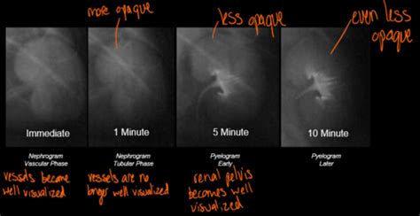 Image result for Nephrogram Phase Timing