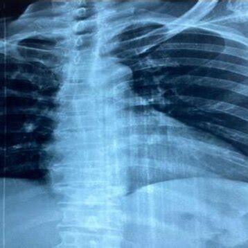 Image result for Normal Bowel Colonoscopy