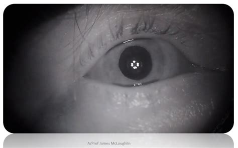 Image result for Positional Vertigo