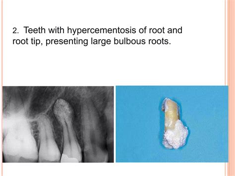 Image result for Principles of Tooth Extraction