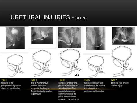 Image result for Urethrogram Technique