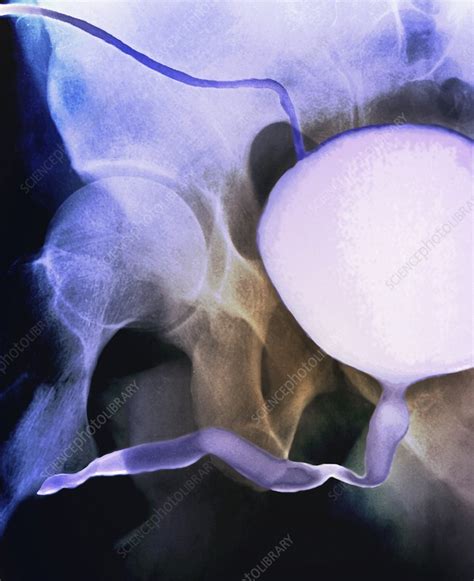 Image result for Voiding Cystourethrogram Image