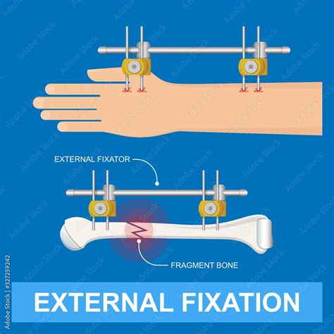 Image result for External Fixator Surgery