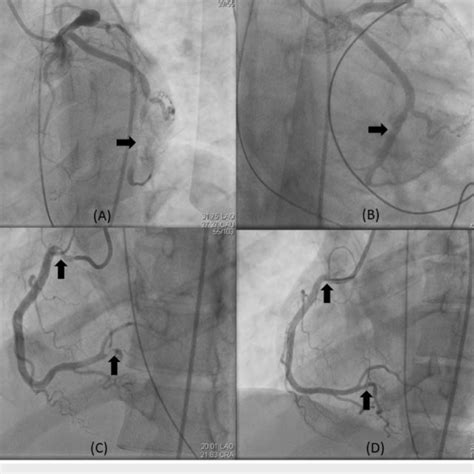 Image result for Peripheral Angiogram