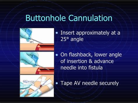 Image result for Buttonhole Invagination