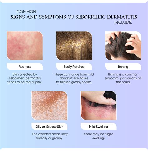 Image result for Seborrheic Dermatitis Contagious
