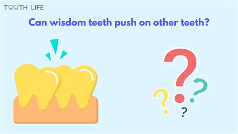 Image result for Wisdom Tooth Overlap