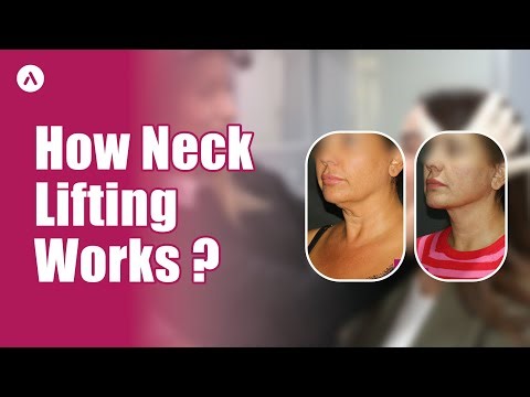 Neck Lift Surgery in Turkey | AKM Clinic Istanbul Best Plastic Surgery Clinic