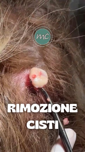 Cyst Removal Procedure Explained by Dr. T. Samarina