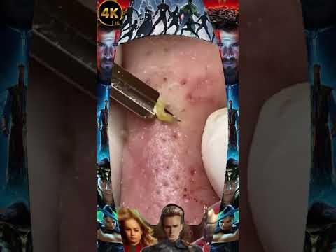 Blackheads Removal | Acne Treatment and Very Satisfying Satisfying Pimple pop #blackheads