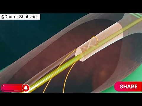 Tibia Fracture - Bone Transport with Ilizarov - IEF 3D-Animation.
