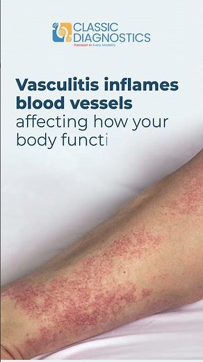 Vasculitis Explained Early Symptoms, Blood Tests, and Why Timely Detection Matters