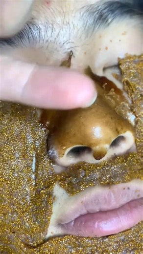 Clean & Clear Pores Facial | Satisfying Blackhead Whitehead Removal