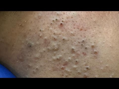 Deep Whitehead Extraction | Satisfying Pimple Popping Video