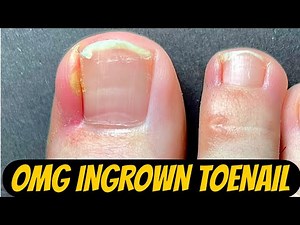 REMOVAL OF A "SHARK TOOTH" INGROWN TOENAIL