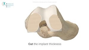 KA-TKA MIKA (Medacta Individualized Kinematic Alignment)