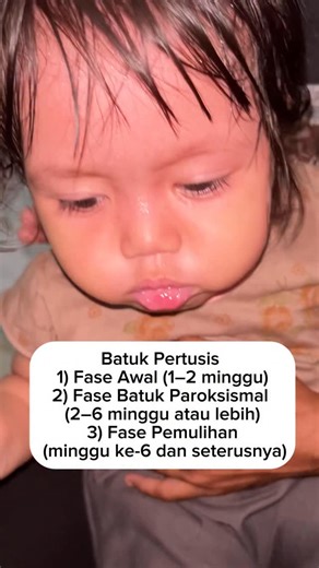 Sella Silvia on Instagram: "Berikut ciri-ciri batuk pertusis (batuk rejan / whooping cough) yang paling umum dan sering dikenali: 1) Fase Awal (1–2 minggu) Mirip flu biasa: • Hidung berair • Demam ringan • Mata berair • Batuk ringan, belum khas • Nafsu makan menurun Pada fase ini banyak orang belum sadar bahwa ini pertusis. ⸻ 2) Fase Batuk Paroksismal (2–6 minggu atau lebih) Ciri khas yang membuat pertusis berbeda: • Batuk parah, bertubi-tubi, cepat, tanpa jeda untuk menarik napas • Setelah batu