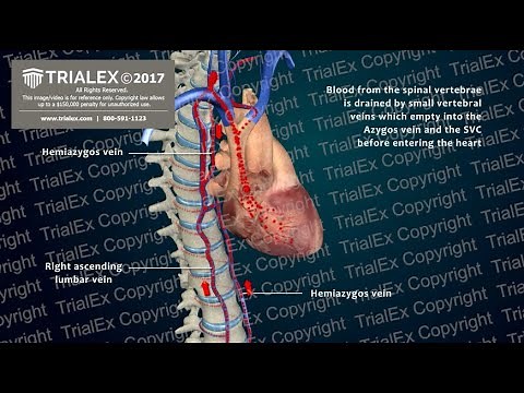 The Mechanism of DIC - Disseminated Intravascular Coagulation