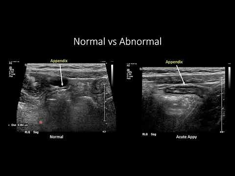 US for Suspected Appendicitis in Children