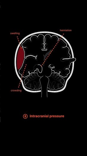Types of Brain Herniations - Shorts