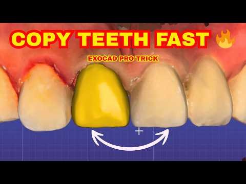 How to Copy Teeth in Exocad 🦷 Fast & Accurate Crown Design Tutorial
