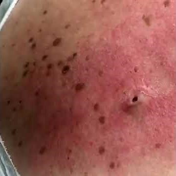 dr pimple popper 2017