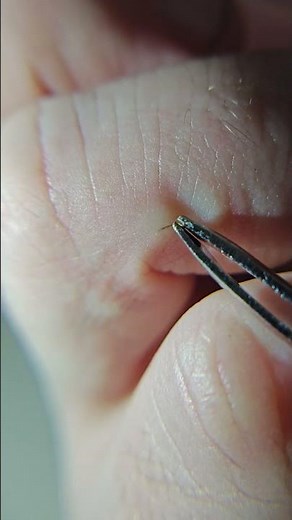 Huge splinter removal